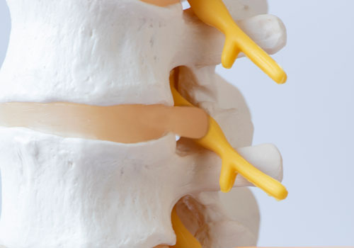 Bulging Disc Treatment and How Chiropractic Care Help in DeLand, Fl